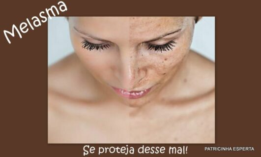 Melasma : O Que é e Como Tratar (março 2024)