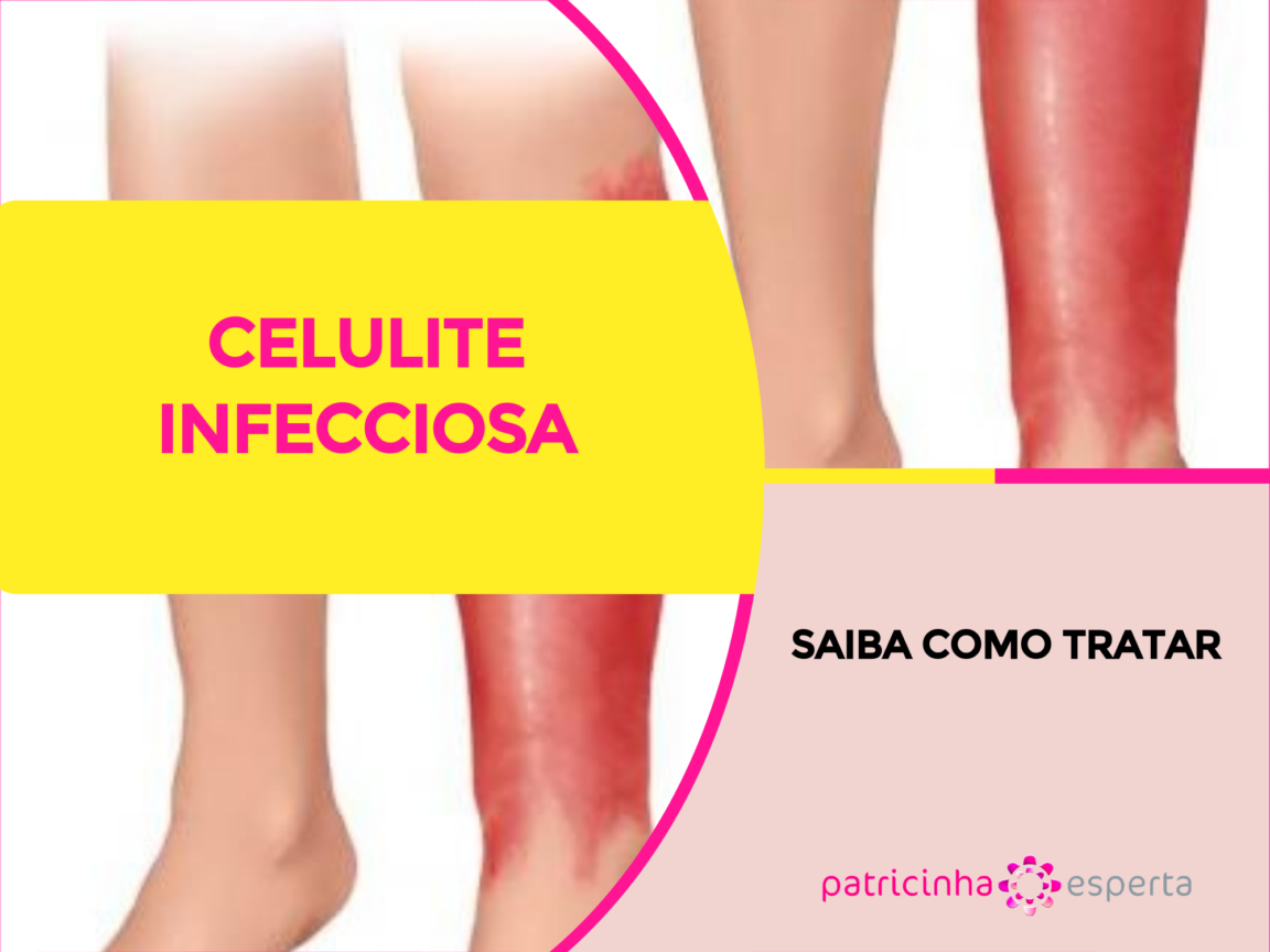 Celulite infecciosa tratamentos- Patricinha Esperta