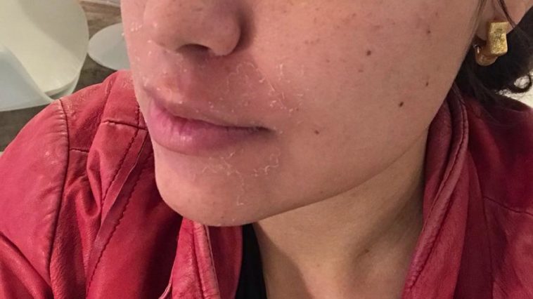 Pele Descascando no Inverno? 10 Dicas De Como Tratar + Resenha