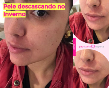 Pele Descascando no Inverno? 10 Dicas De Como Tratar + Resenha